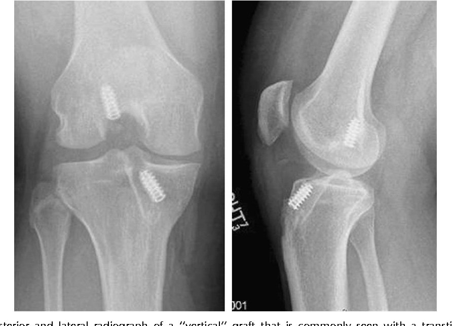 Rehabilitation Post ACL Reconstruction OrthopaedicPrinciples Rehabilitation Post ACL Reconstruction OrthopaedicPrinciples