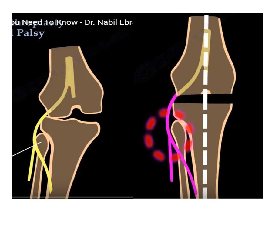 Total Knee Arthroplasty Peroneal Palsy OrthopaedicPrinciples