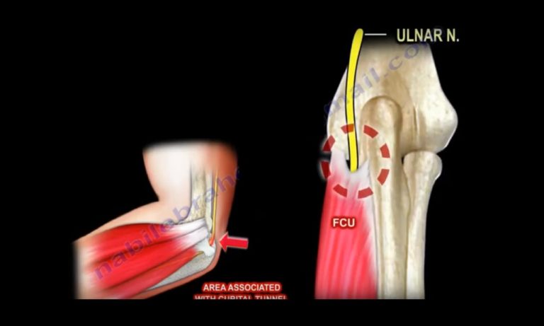 Nerve Compressions Of The Upper Extremity — OrthopaedicPrinciples.com