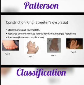 Patterson Classification of Constriction Band Syndrome ...