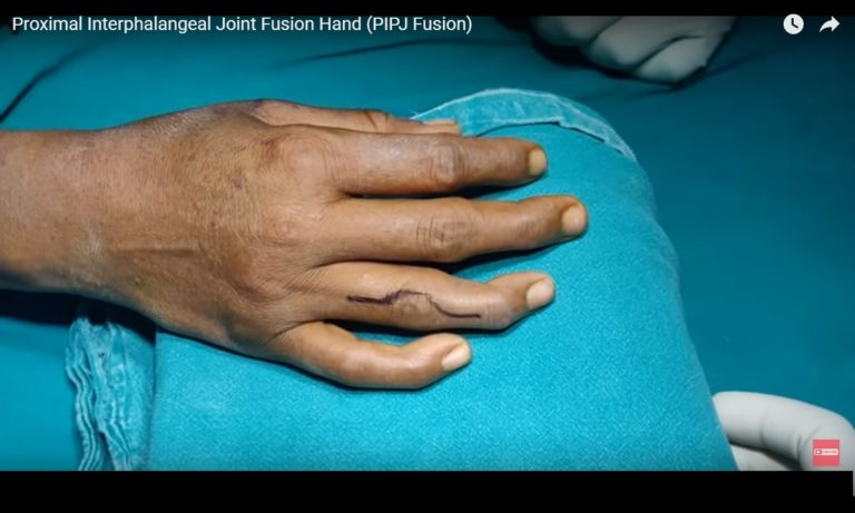 PIP Joint Injuries — OrthopaedicPrinciples.com
