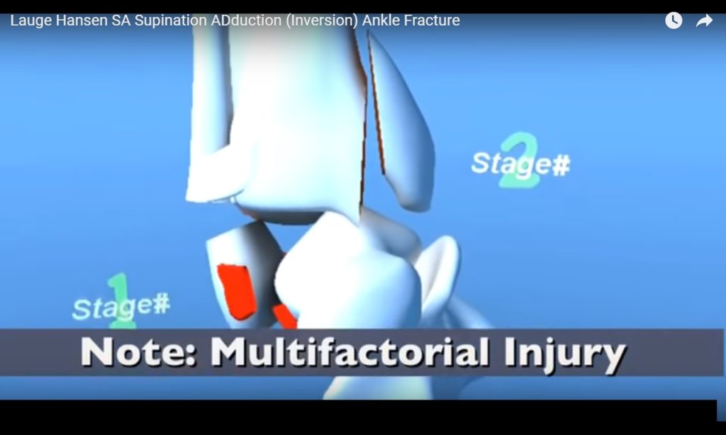 Supination-Adduction in Lauge Hansen Classification ...