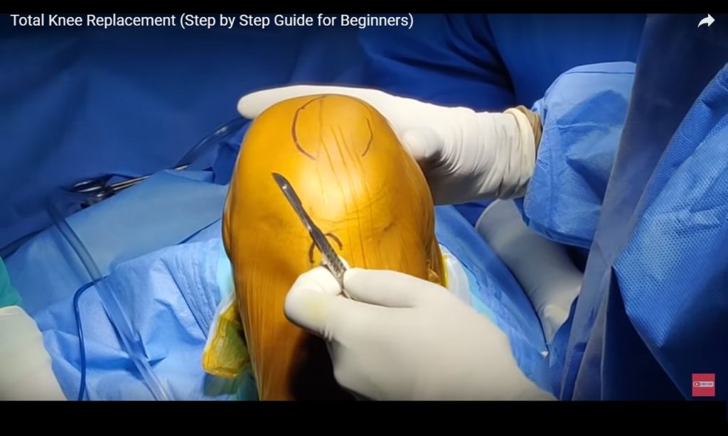 Cruciate Retaining TKR — OrthopaedicPrinciples.com