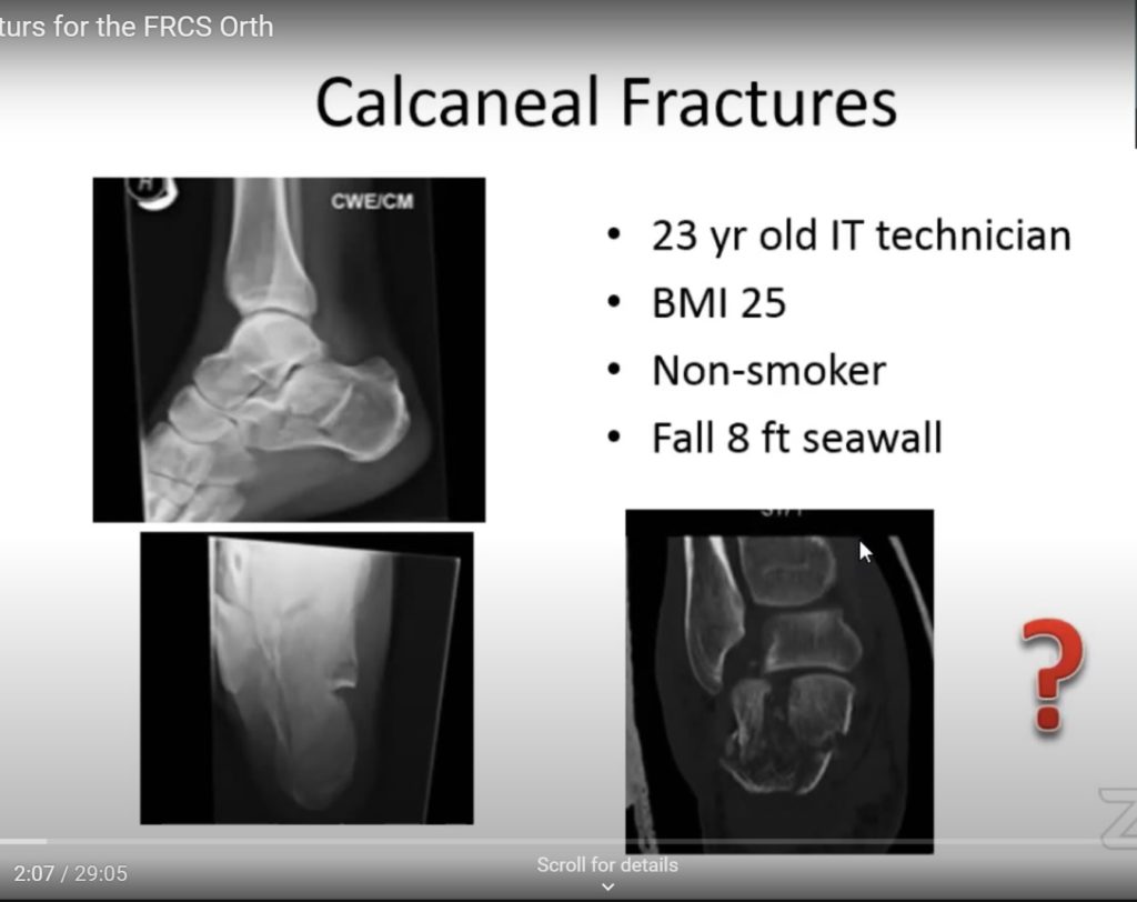 UK heel trial — OrthopaedicPrinciples.com