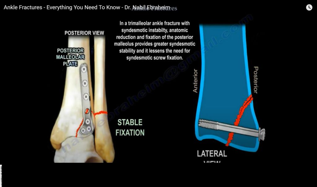 Overview of Ankle Fractures — OrthopaedicPrinciples.com