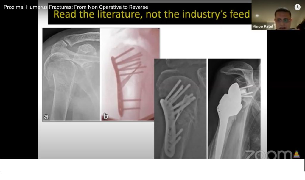 Proximal Humerus Fractures: From Non Operative to Reverse ...