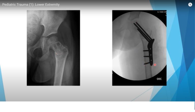 Overview of Paediatric Lower Extremity Trauma — OrthopaedicPrinciples.com
