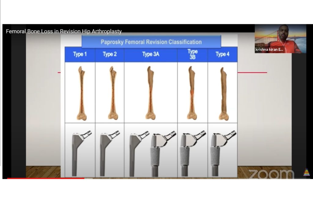 Femoral Bone Loss in Revision Hip Arthroplasty — OrthopaedicPrinciples.com