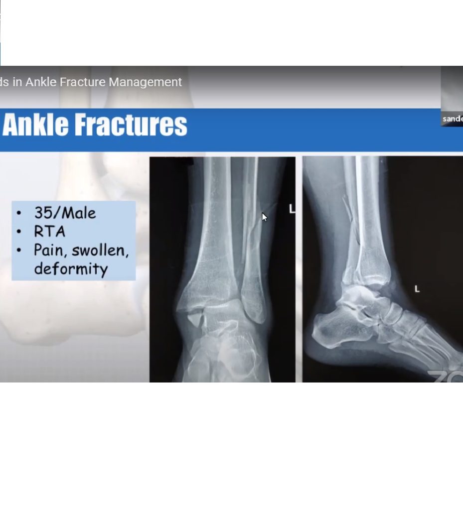 Current Trends in Ankle Fracture Management — OrthopaedicPrinciples.com