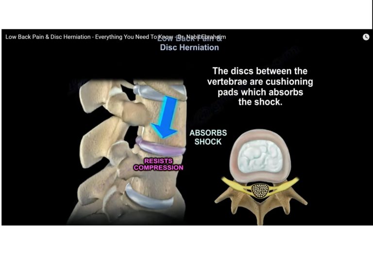 Low Back pain, Spine fractures, Thoracic Disc herniation, Waddell signs ...