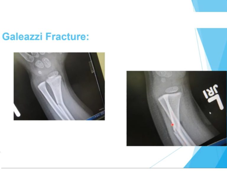 Paediatric Forearm and Hand fractures — OrthopaedicPrinciples.com