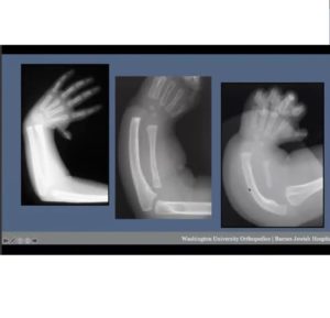 Congenital Hand Differences — OrthopaedicPrinciples.com