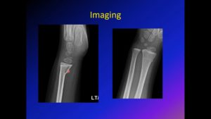 Torus Fractures (Buckle fractures) — OrthopaedicPrinciples.com