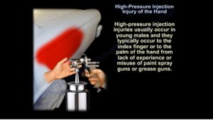 High Pressure Injection Injury of the Hand — OrthopaedicPrinciples.com