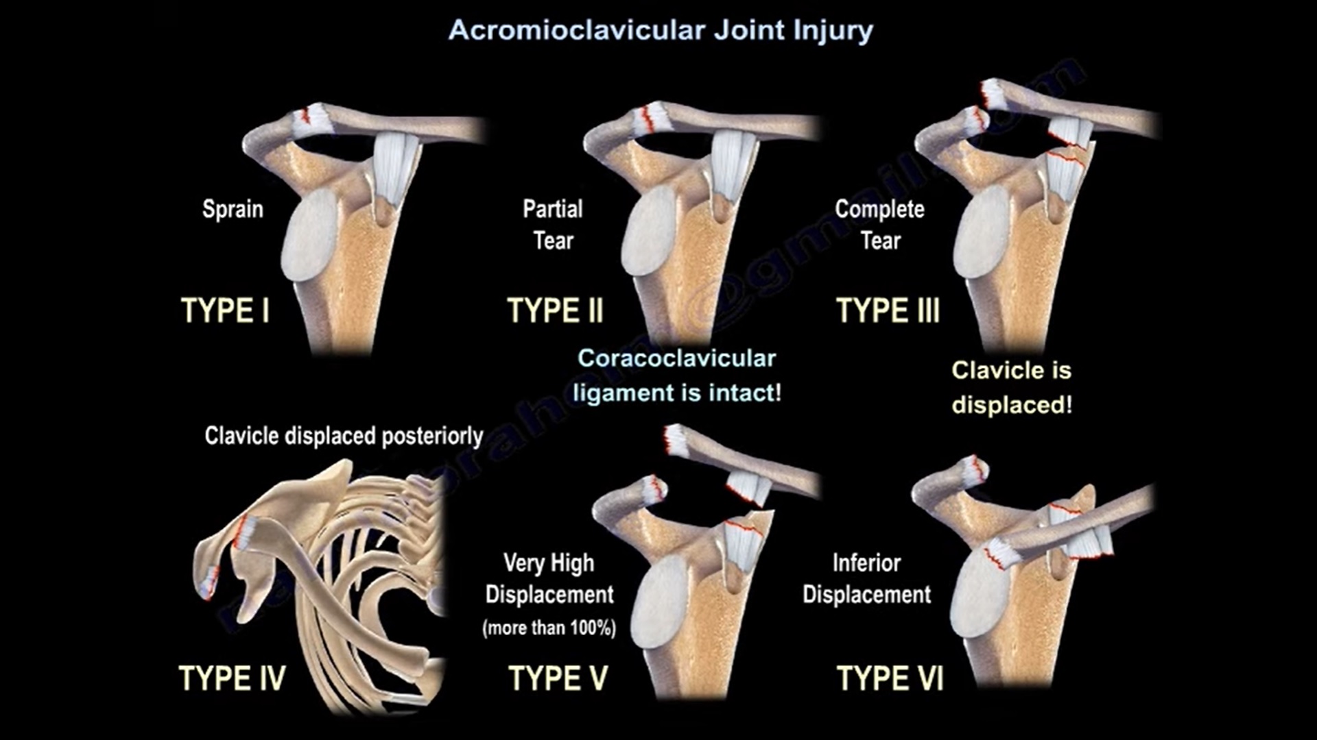 Acromioclavicular Joint Injury OrthopaedicPrinciples