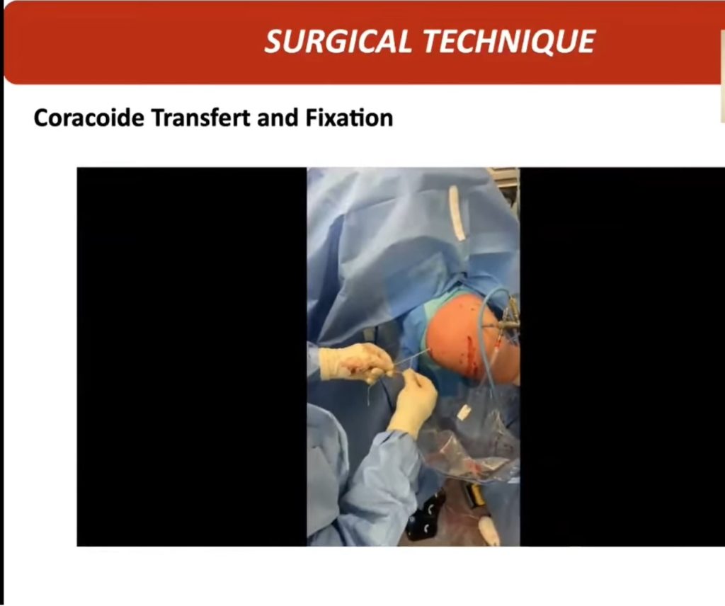 Arthroscopy-Guided Latarjet for Anterior Shoulder Instability ...