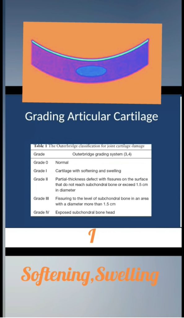 Outerbridge Classification of Cartilage defects — OrthopaedicPrinciples.com