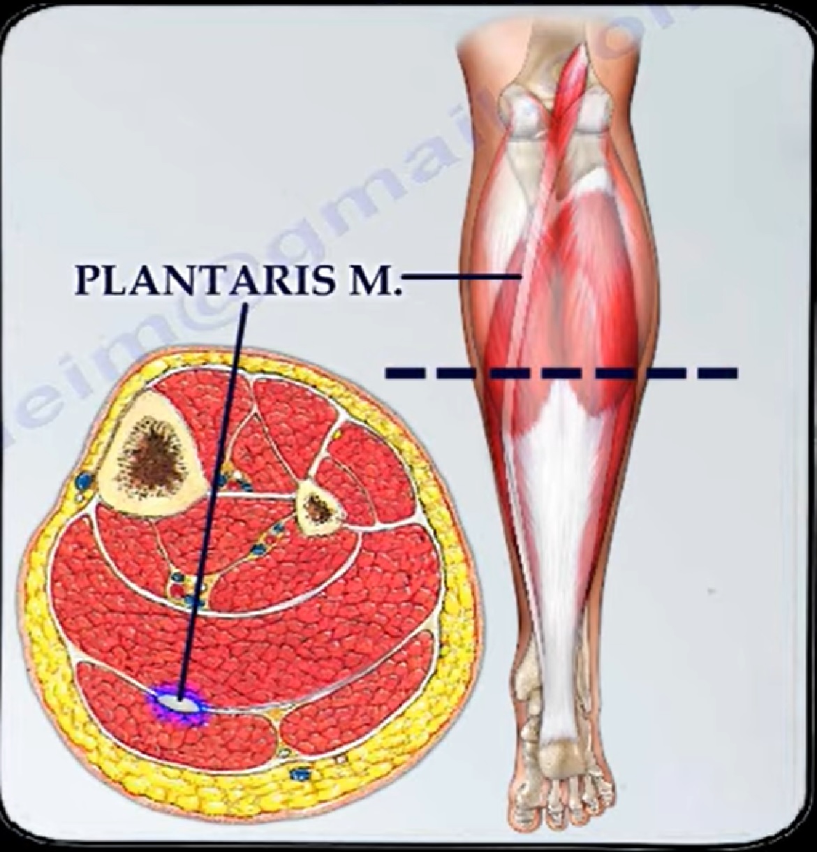 Plantaris Tendon Rupture OrthopaedicPrinciples Plantaris Tendon Rupture OrthopaedicPrinciples