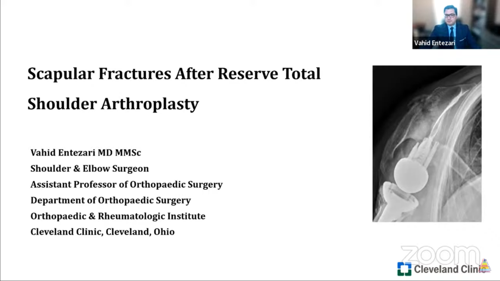 Scapular Fractures after Reverse Shoulder Arthroplasty ...