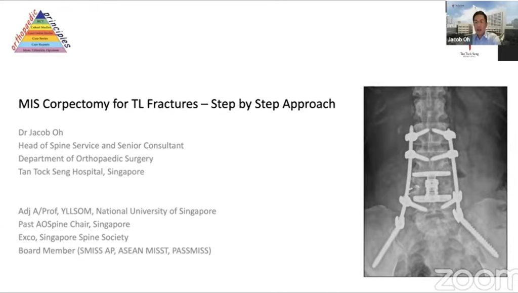 MIS Corpectomy for Thoracolumbar Fractures — OrthopaedicPrinciples.com