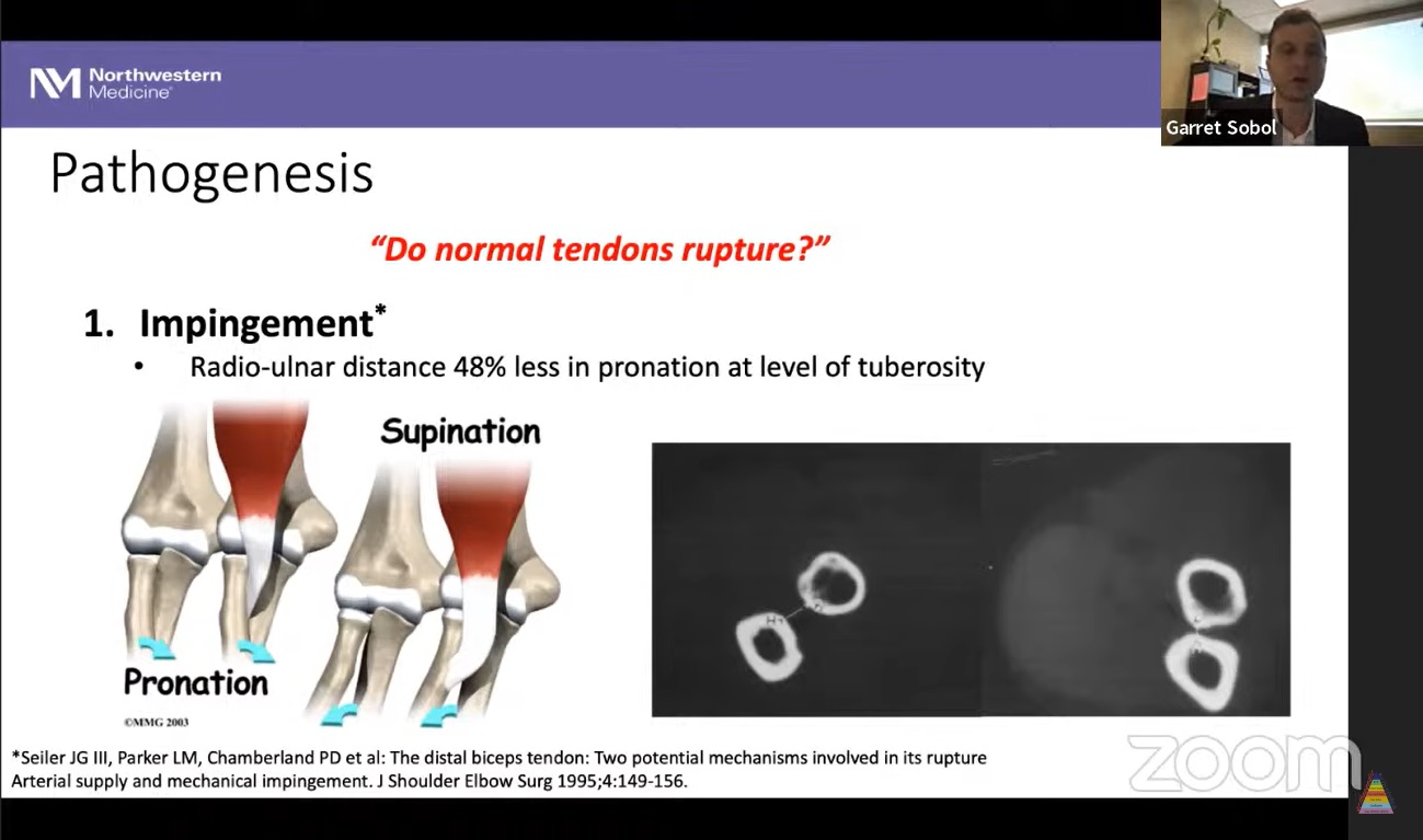 Distal Biceps Tendon Injuries OrthopaedicPrinciples Distal Biceps Tendon Injuries OrthopaedicPrinciples
