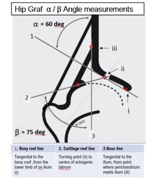 Alpha and beta angles in DDH — OrthopaedicPrinciples.com
